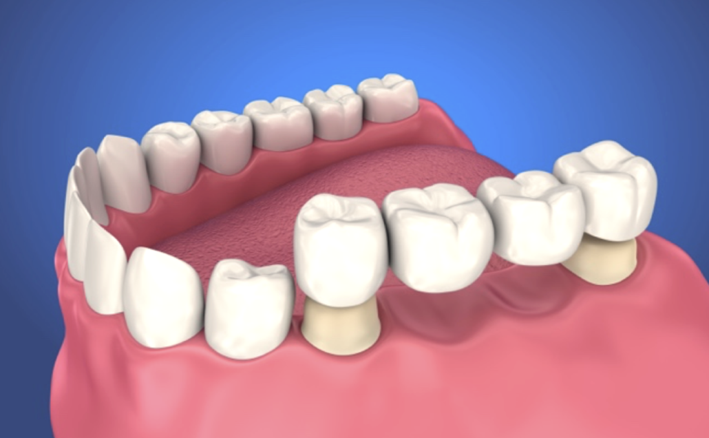 Tannbro - Opitz Tannhelsesenter
